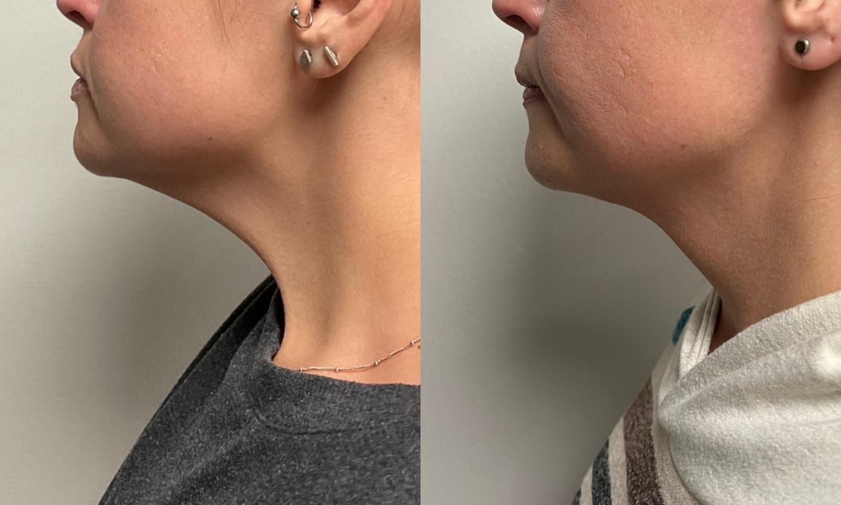Before & After: Kybella
